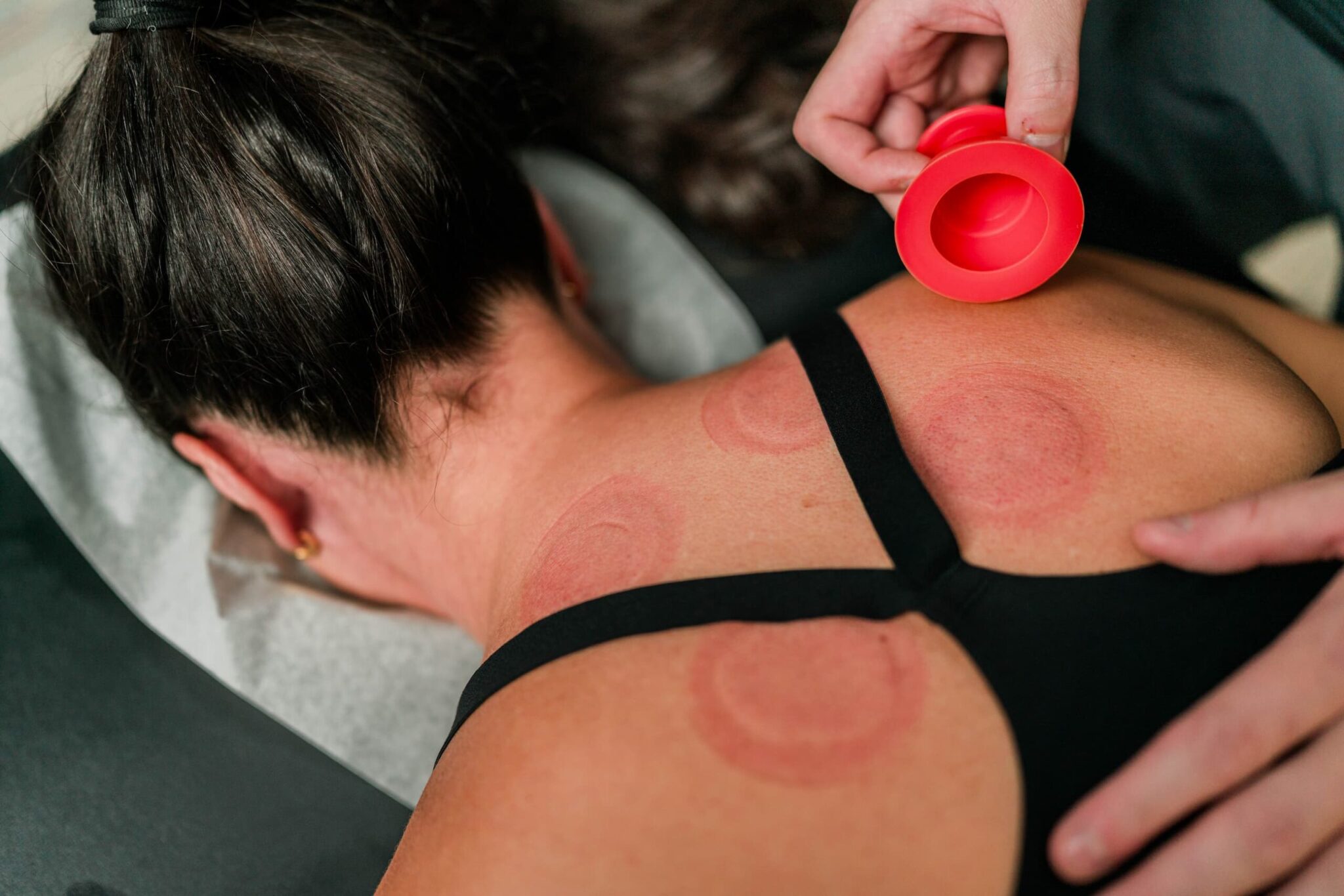 Chiropractic Cupping – HealthSource Chiropractic